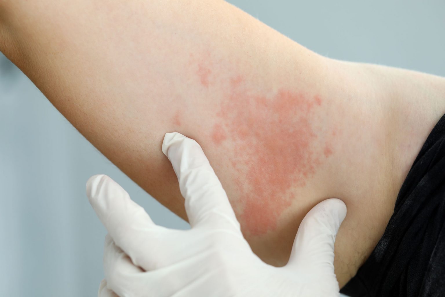 ClearSkin ClearSkin